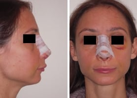 dopo-rinoplastica-foto-6 - Rinoplastica Oggi